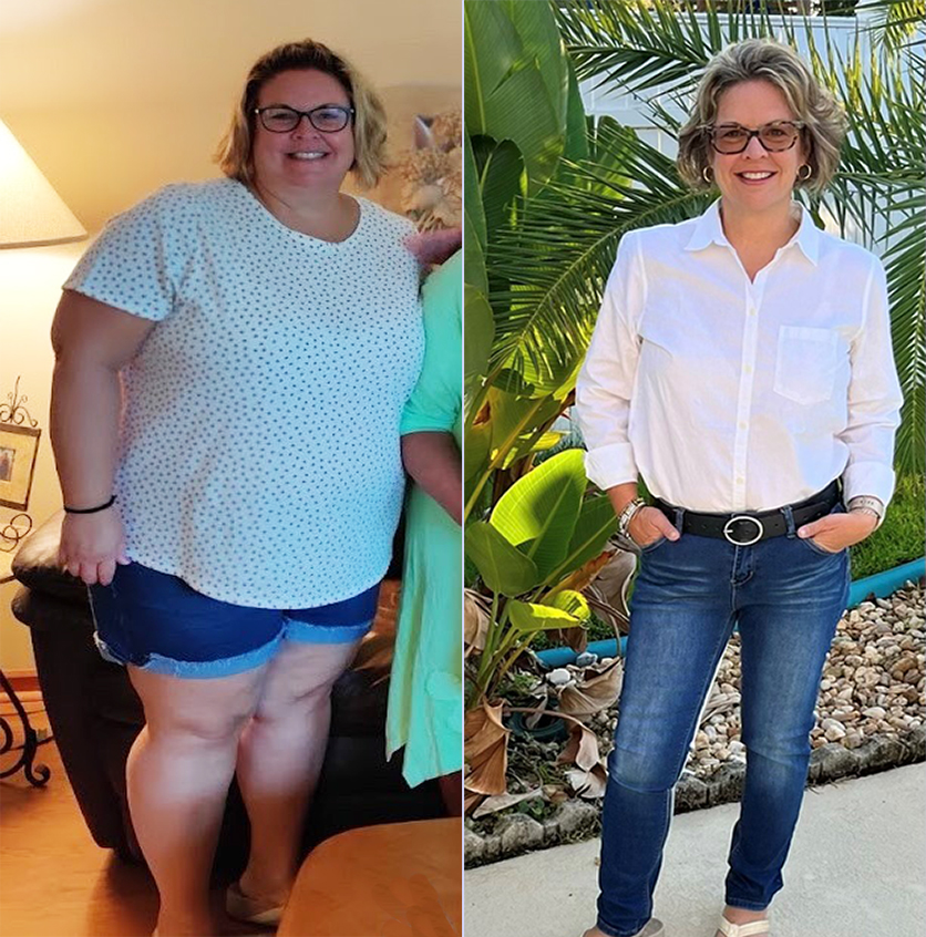 One year later - Bariatric surgery patient loses 145 pounds | HCA Florida
